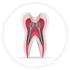 ≡ Dent sur Pivot → Prix de l'intervention, Procédure et Durée de Vie