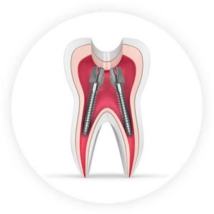 ≡ Dent sur Pivot → Prix de l'intervention, Procédure et Durée de Vie