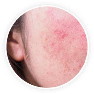 ≡ Lupus → Symptômes, Diagnostic, Traitements et Espérance de Vie