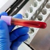 ≡ Hématocrite Elevé : Interprétation, Causes et Solutions