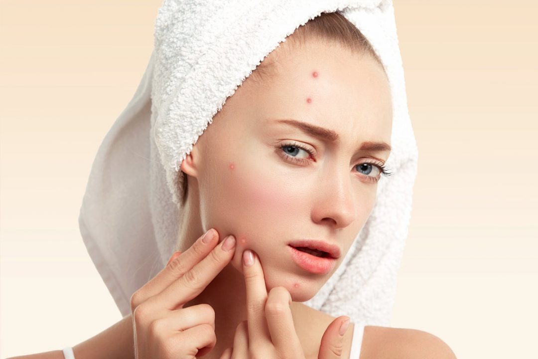 ≡ Bouton Blanc : Faut-il le Percer ? Comment les Eliminer et les Eviter