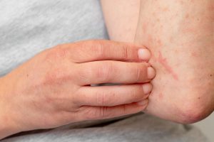 ≡ Urticaire : Causes, Symptômes, Diagnostic et Traitements Possibles