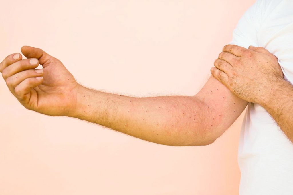 ≡ Urticaire : Causes, Symptômes, Diagnostic et Traitements Possibles