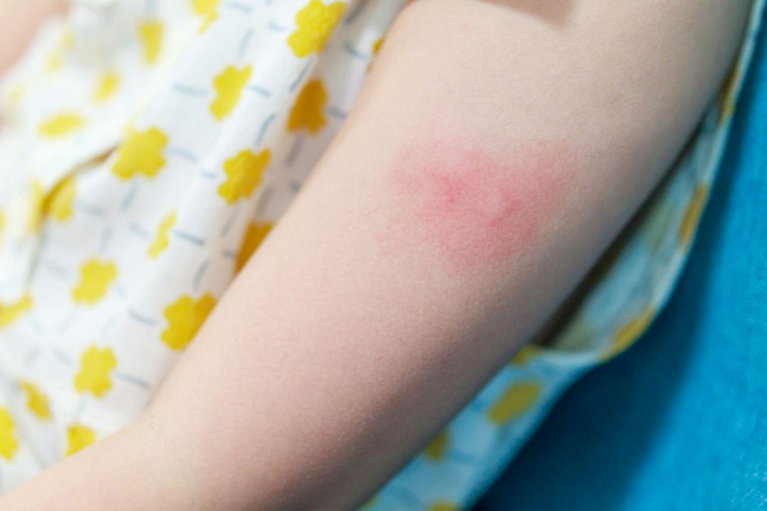 ≡ Urticaire : Causes, Symptômes, Diagnostic et Traitements Possibles